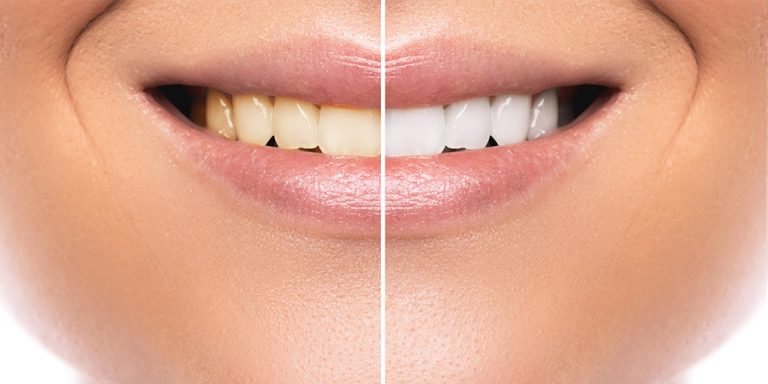 Tens Ways To Look After Your Teeth | Dentist Wantirna South